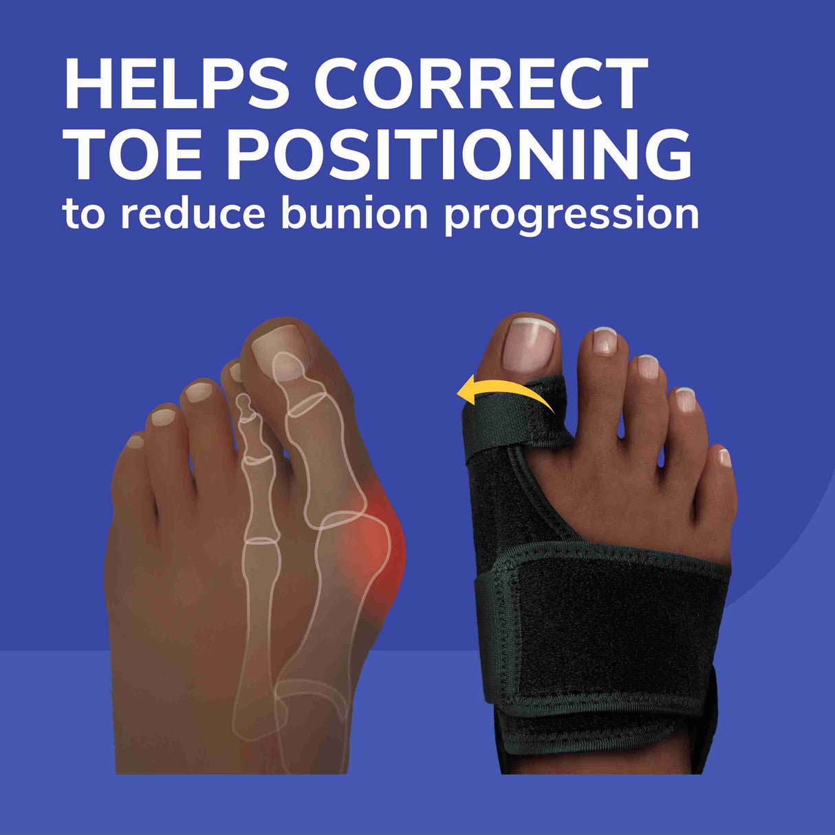 Bunion Relief & Toe Corrector – DrScholls